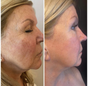 Aesthetics Gallery | Glo Esthetics in Alpine, Utah